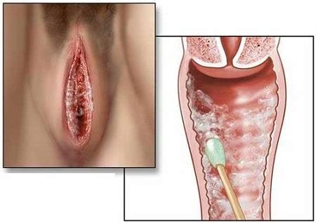 Tìm Hiểu 5 dấu hiệu nhiễm nấm Candida ở nam giới và nữ giới hiện nay
