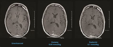 Vueway™ Gadopiclenol Practical Considerations For Use Applied Radiology