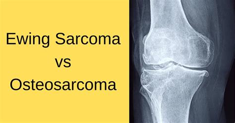 Ewing Sarcoma Vs Osteosarcoma Key Differences Explained