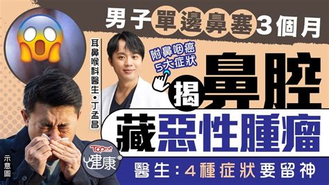 鼻咽癌｜男子單邊鼻塞3個月 揭鼻腔藏惡性腫瘤 醫生：4種症狀要留神【附鼻咽癌5大症狀】