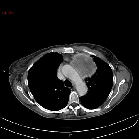 Primary Sarcomatoid Carcinoma Of The Lung Pacs