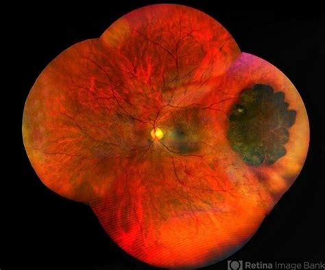 Choroidal Nevus Retina Image Bank