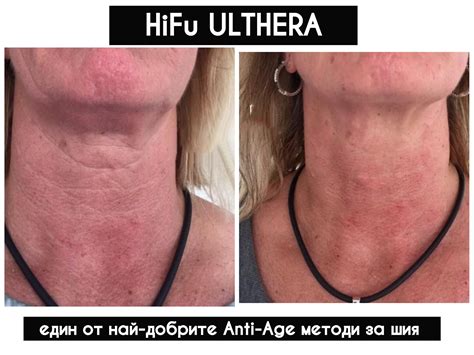 Подмладяване и стягане с Hifu Д р и Д р Неделчеви