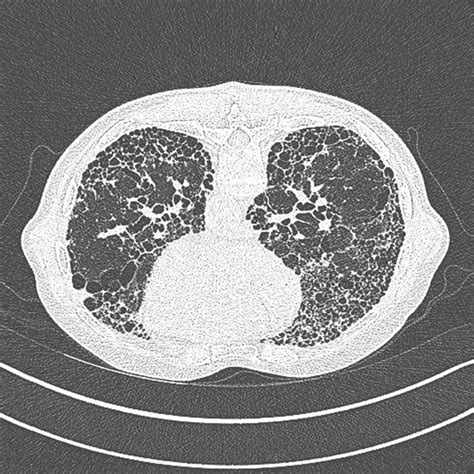 Computed Tomography Imaging Of The Chest Displaying Extensive Usual Download Scientific Diagram