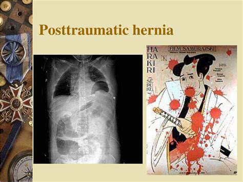 Ppt Diaphragm And Hiatus Hernia Powerpoint Presentation Free