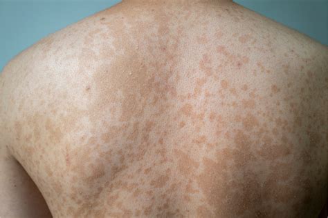 Pityriasis Versicolor Natural Treatments That Work