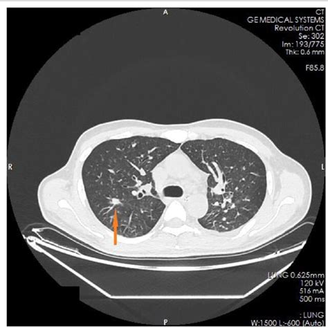 Ct Pictures Displaying Multiple Tuberculosis Lesions Throughout The