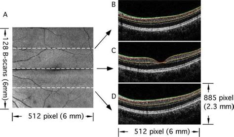 The Oct Macular Cube Scan A Fundus Picture Showing Extent Of Cube