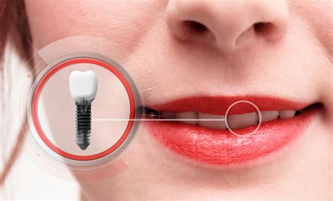 Dentist Breaks Down Dental Implant Procedure Step By Step