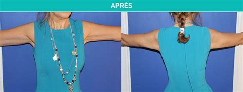 Chirurgien plastique esthétique Nantes Dr Laurent Martinet Lifting de la face interne des bras
