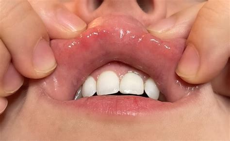 Botched Lip Filler 2 Years Later Rplasticsurgery