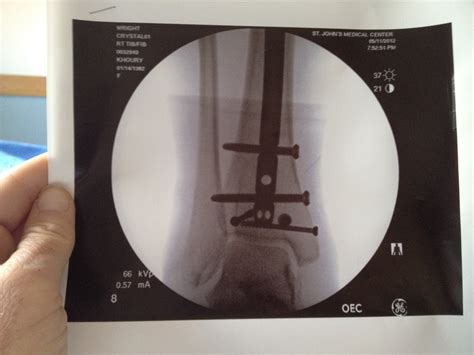 Breaking The Ankle Tibula And Fibula Crystal B Wright