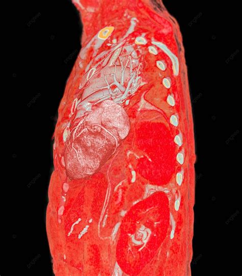 3d Rendering Of Pulmonary Artery Branch In Cta Scan Of Pulmonary