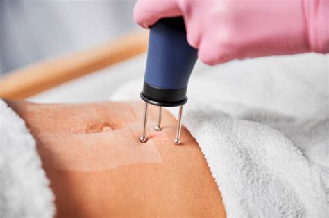 Stretch Mark Management Central Dermatology