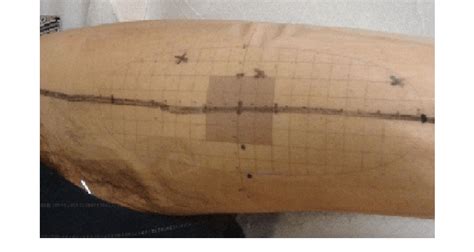 Preoperative Ultrasound Examination Of The Left Thigh The Location Of