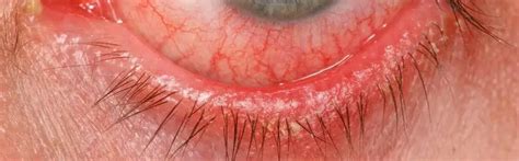 Eyelid Conditions Murdoch Eye Centre