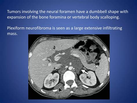 Retroperitoneal Masses Radiology Ppt