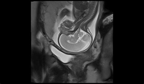 Fetal Brain Mri Sagittal Localiser Images Mrimaster