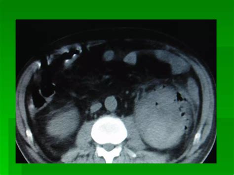Ct Emphysematous Pyelonephritis Ppt