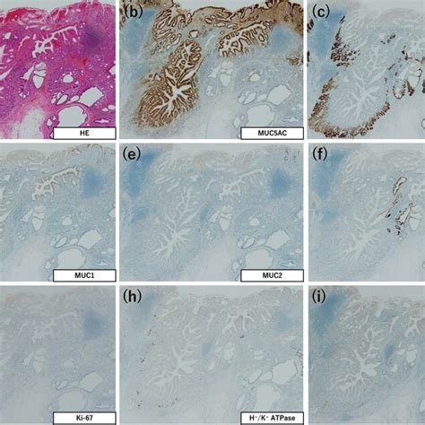Immunohistochemical Features Of Patient 1 A Hematoxylin And Eosin
