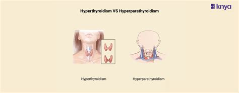 Hyperthyroidism Vs Hyperparathyroidism Symptoms Causes And Treatment