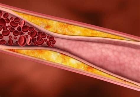 Penyebab Penyakit Aterosklerosis Ilmu