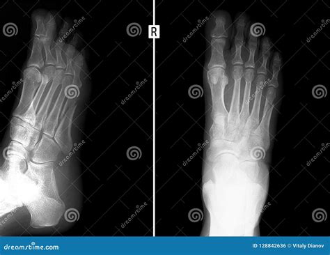 Foot Mri Metatarsal Shaft Stress Fracture Collage Royalty Free Stock