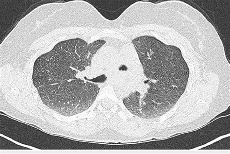 Diffuse Centrilobular Ground Glass Nodules Along The Bronchovascular