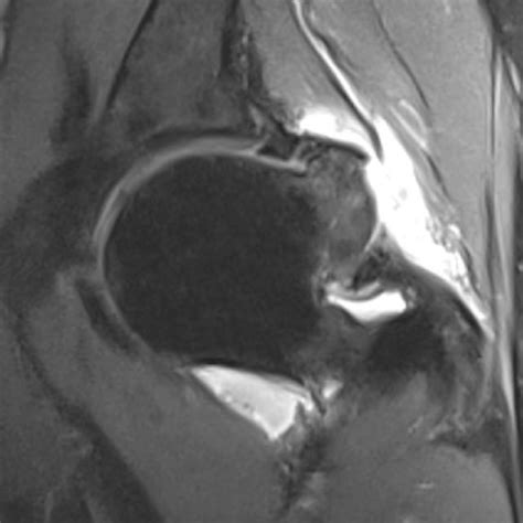 Magnetic Resonance Arthrogram Showing Anterolateral Labral Tear And Download Scientific Diagram