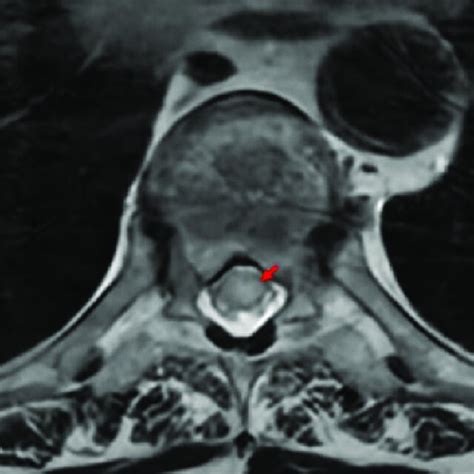 Mri Of The Thoracic Spine Axial T2 Weighted Image Showing Hyperintense Download Scientific