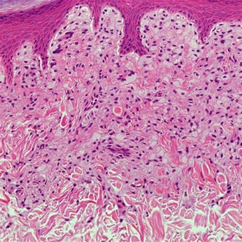 A Multiple Yellowish Patches Were Observed Along Palmar Crease B Download Scientific
