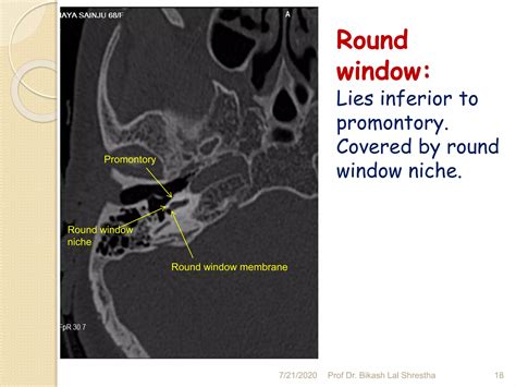 How To Read Ct Scan Temporal Bone A Dhulikhel Hospital Kathmandu