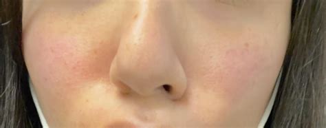 Mild Lupus Malar Rash Rdrwillpowers