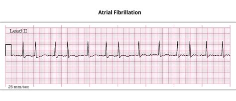 Mitral Stenosis Keyhole And Robotic Heart Surgery In London