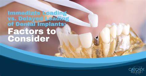 Immediate Loading Vs Delayed Loading Of Dental Implants Factors To