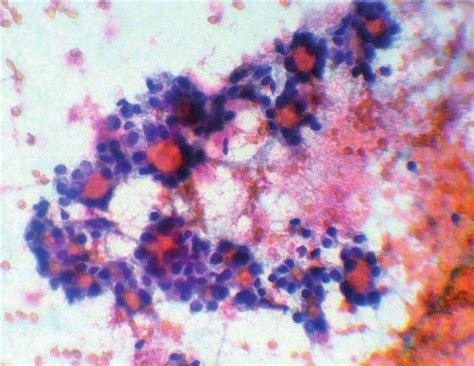 Follicular Cells With A Microfollicular Pattern Diff Quick Stain