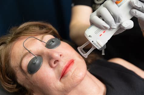 Actinic Keratosis Treatment In Fort Collins Xanadu Med Spa
