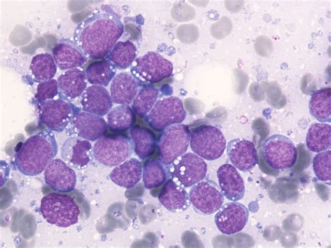 Lymphome De Burkitt Drbeckmann