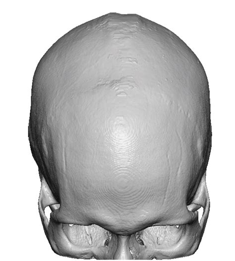 Right Coronal Dip Skull Defect 3d Ct Scan Dr Barry Eppley Explore