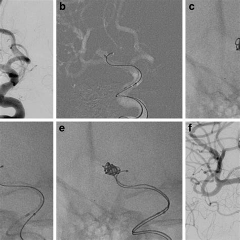 A Unruptured Aneurysm Of Middle Cerebral Artery Proximal Segment M1