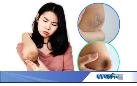 কনুইয়ের কালো দাগ দূর করার ৩ উপায়