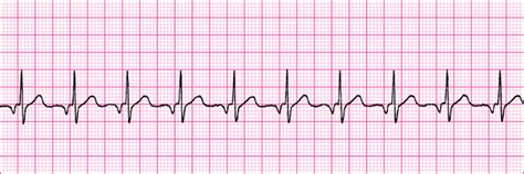 Solved Atrial Fibrillation Afibaccelerated Junctional