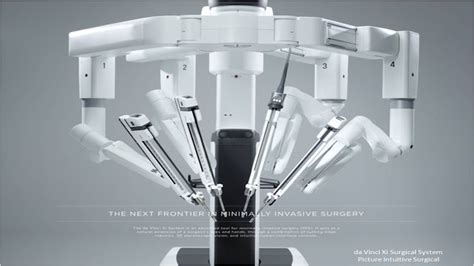 1robot Assisted Surgery For Gastrointestinal Gi Cancers