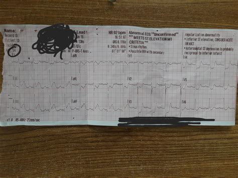 Post Rosc Gcs 15 R Ekgs