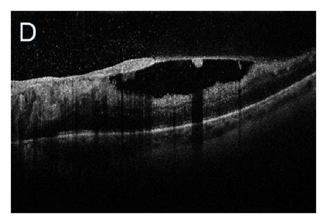 Proliferative Diabetic Retinopathy With Neovascularization Of The Disc