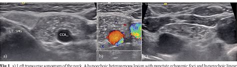 Figure 2 From Ectopic Cervical Thymus As A Rare Cause Of Pediatric Neck