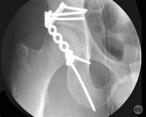 Peripheral Posterior Wall Acetabular Fracture Dislocation