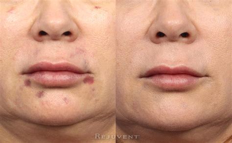 How To Minimize Bruising After Lip Injections
