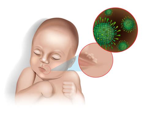 160 Virus De Lherpès Illustrations Stock Illustrations Graphiques