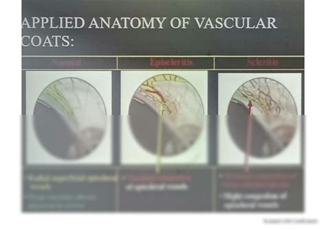 SOLUTION Scleral Pathology Lec Studypool